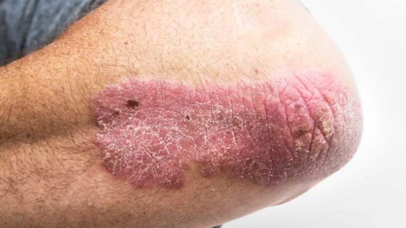 Patient's Mental Health Impacts Rating of Psoriasis Severity