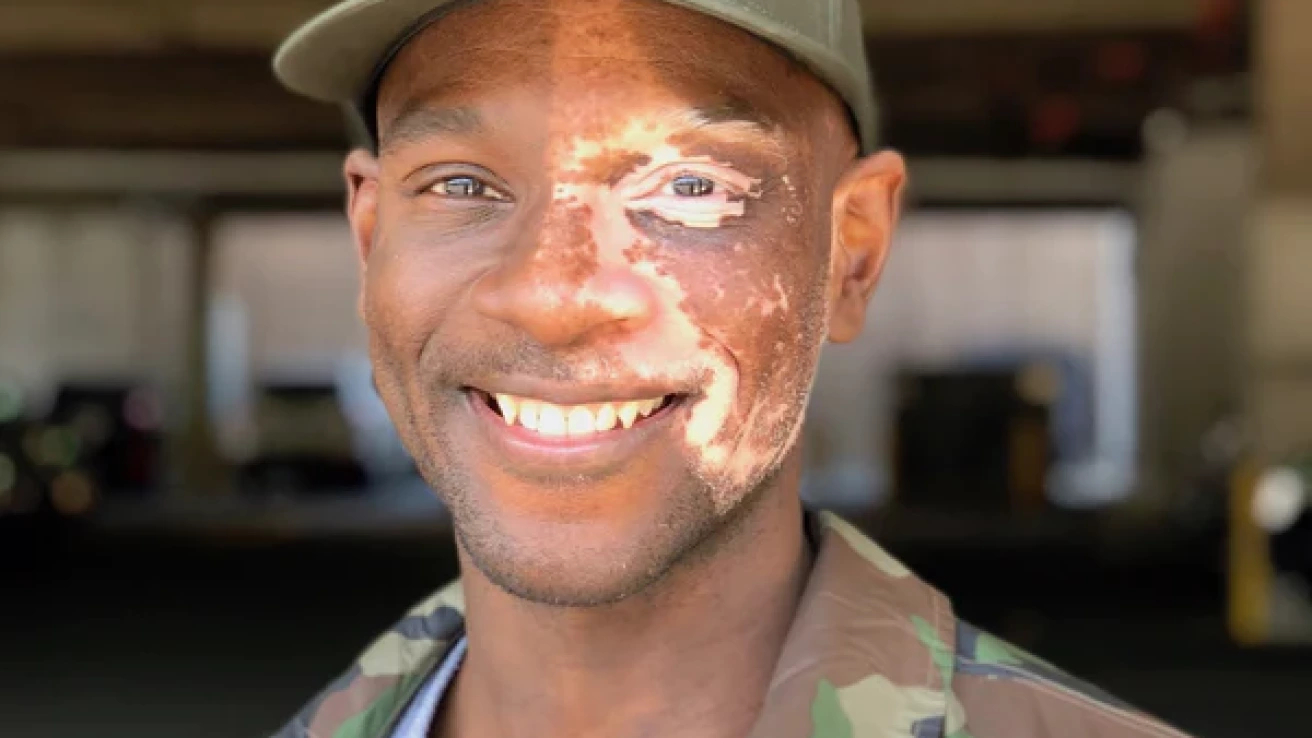 Advice for Vitiligo Patients - MDNewsline