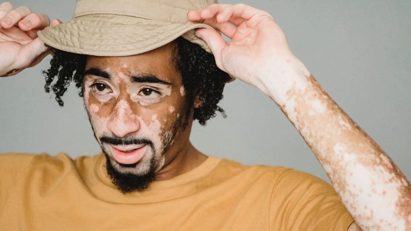 How Trained Immunity and Vitiligo Are Connected