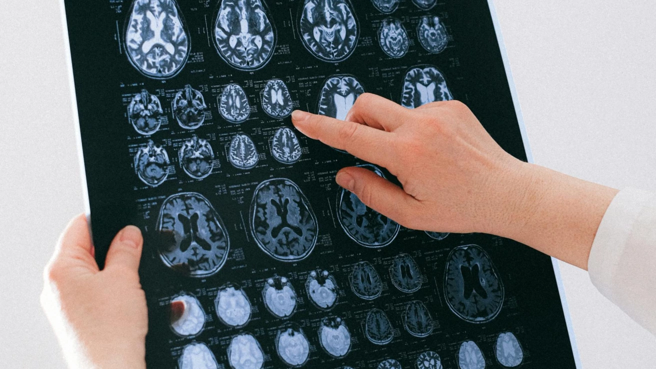 Normative Modeling Uncovers Early Alzheimer Neuroimaging Patterns ...