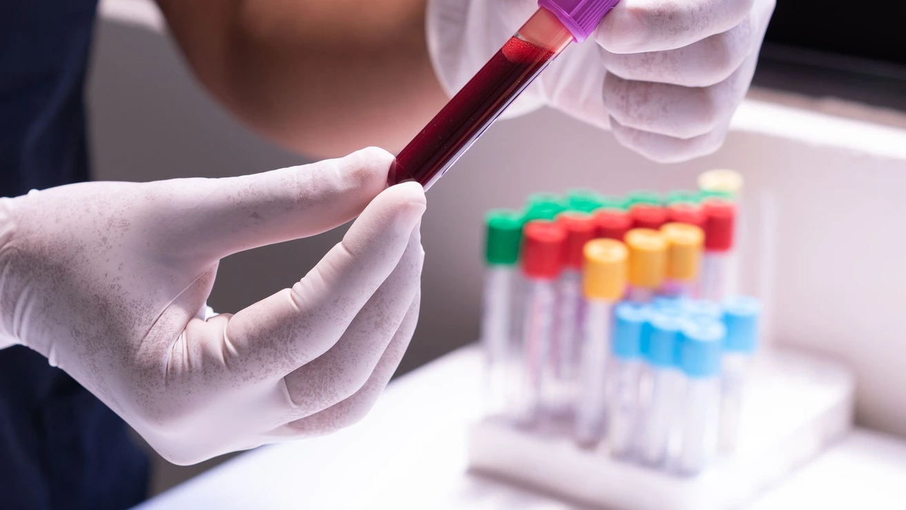 Thrombocytosis and Platelet-Derived Microparticle Generation in Sickle ...