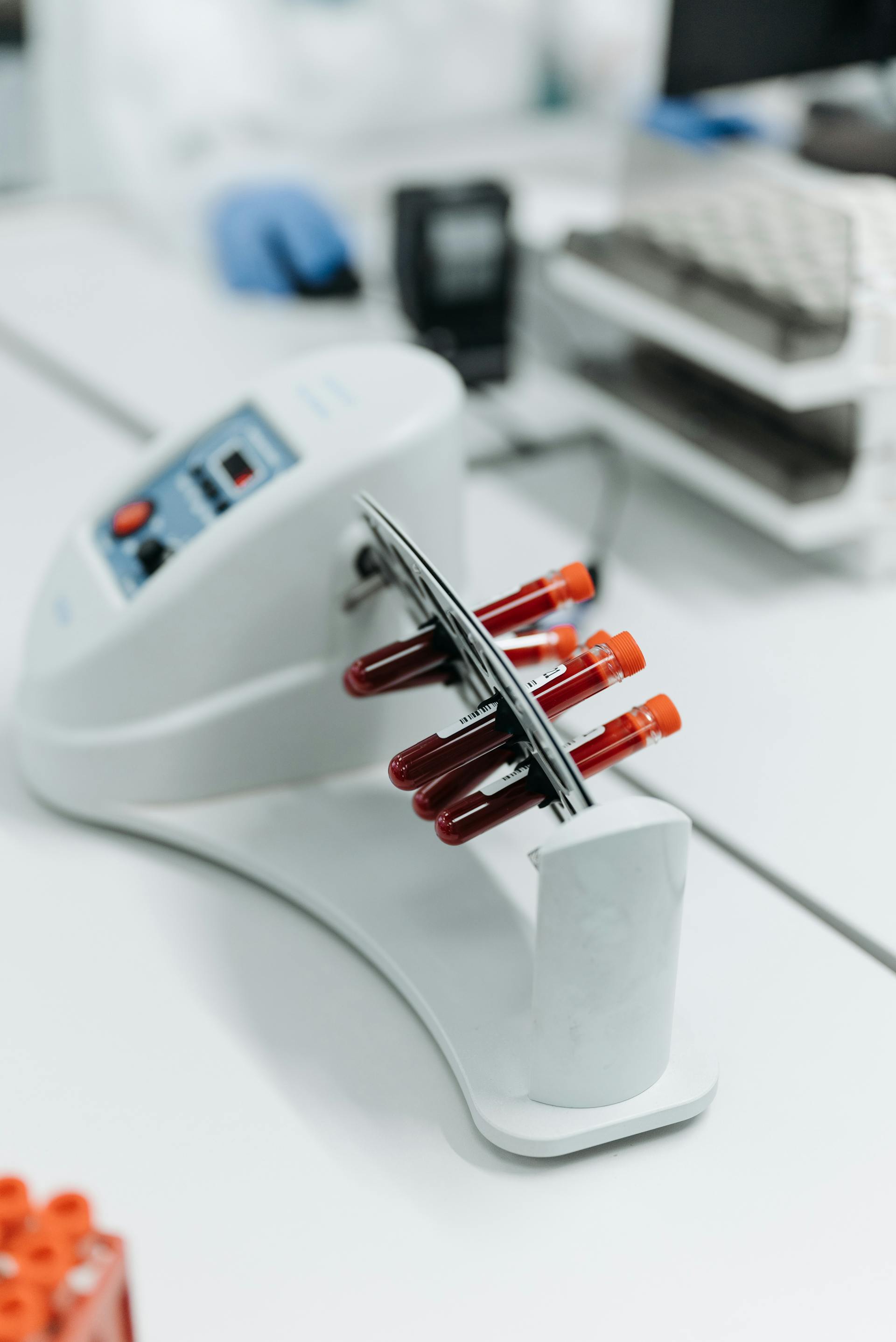 Elevated LDL-C/HDL-C Ratio as a Predictor of Hyperuricemia - MDNewsline